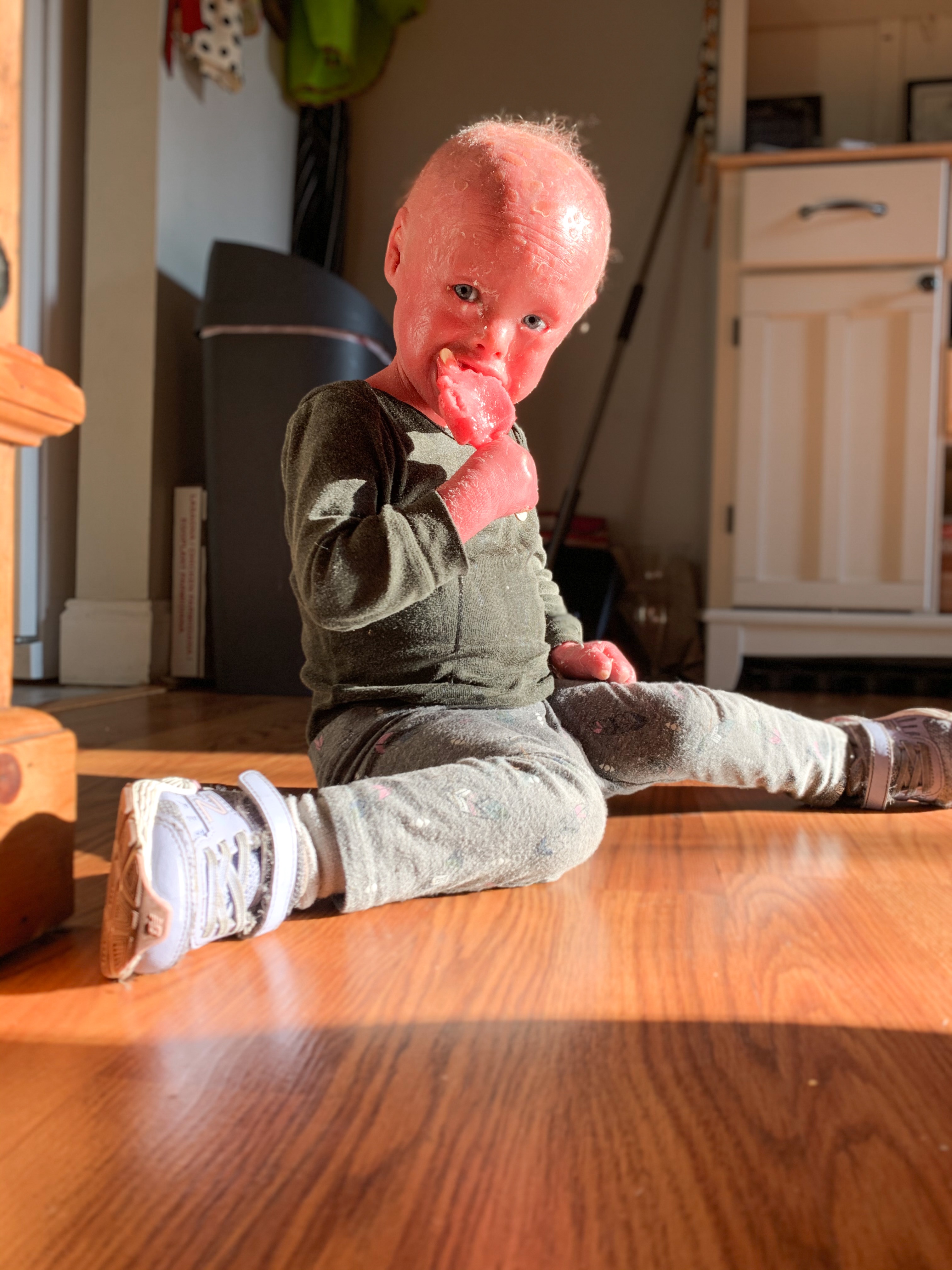 Ichthyosis Awareness Month: Why We Chose Genetic Testing